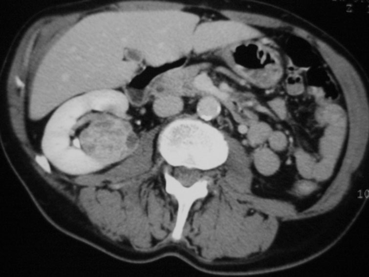 Cancer du rein - Urologie Marseille